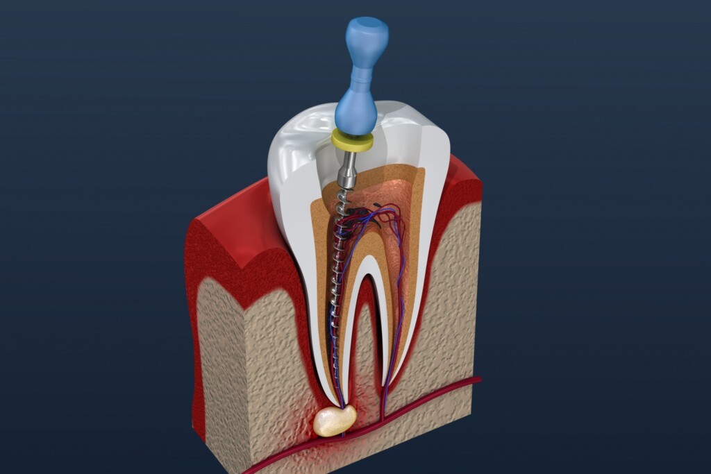 Are Root Canals Safe Pros And Cons Of Root Canal Medical Center